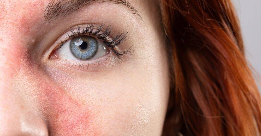 mild rosacea
